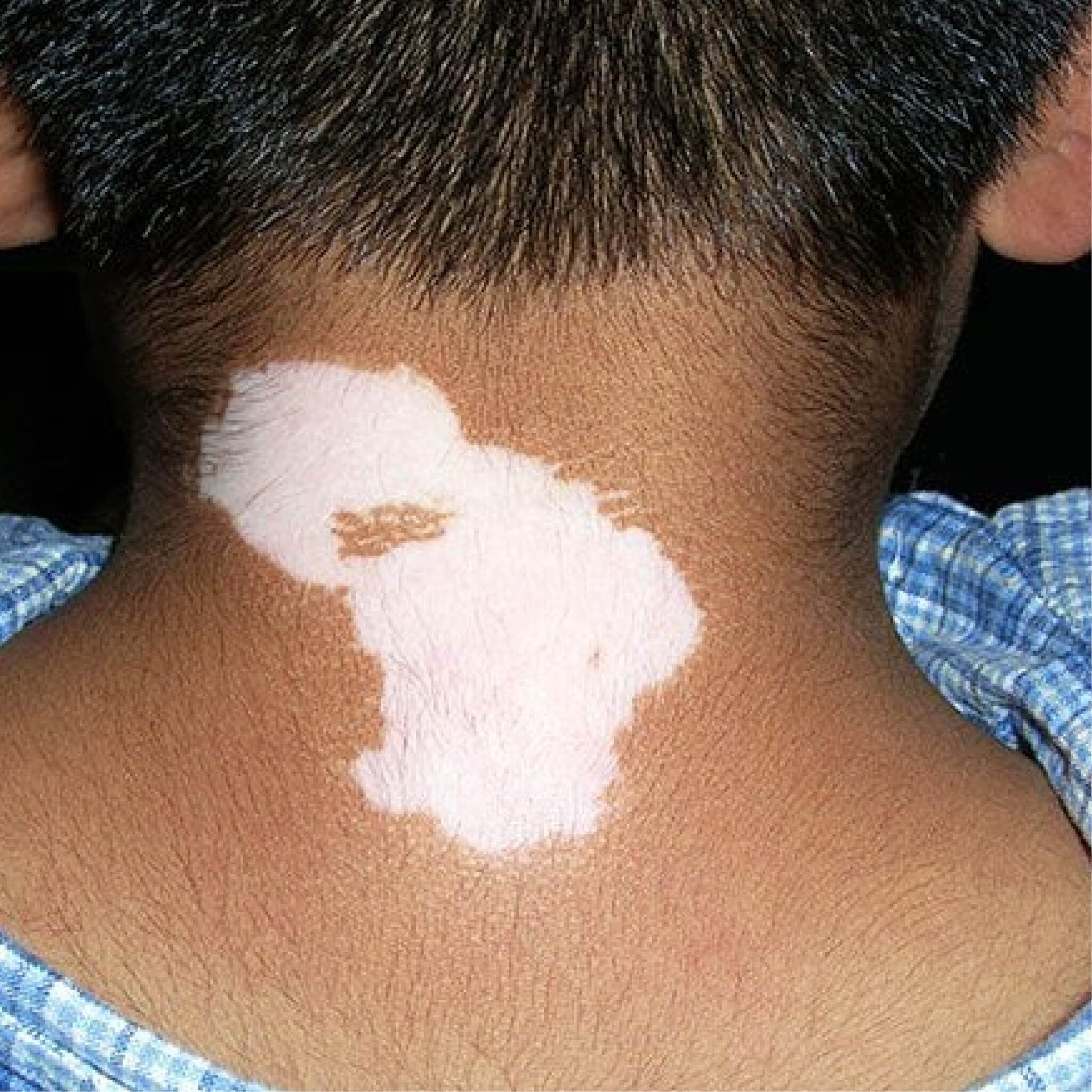 Vitiligo | Good Living Medical Centre