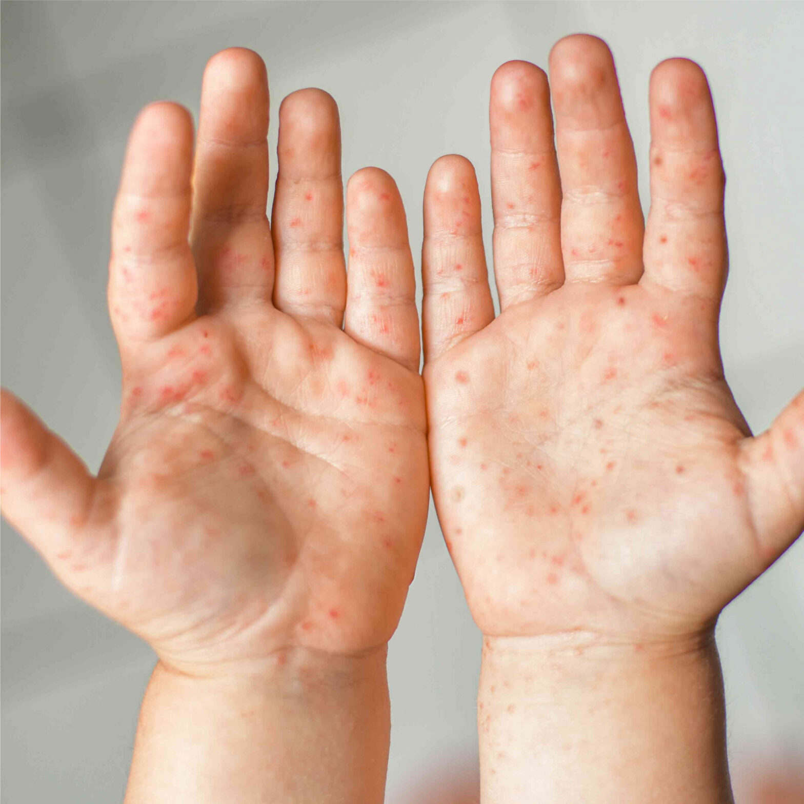 Hand, Foot, and Mouth Disease | Good Living Medical Centre